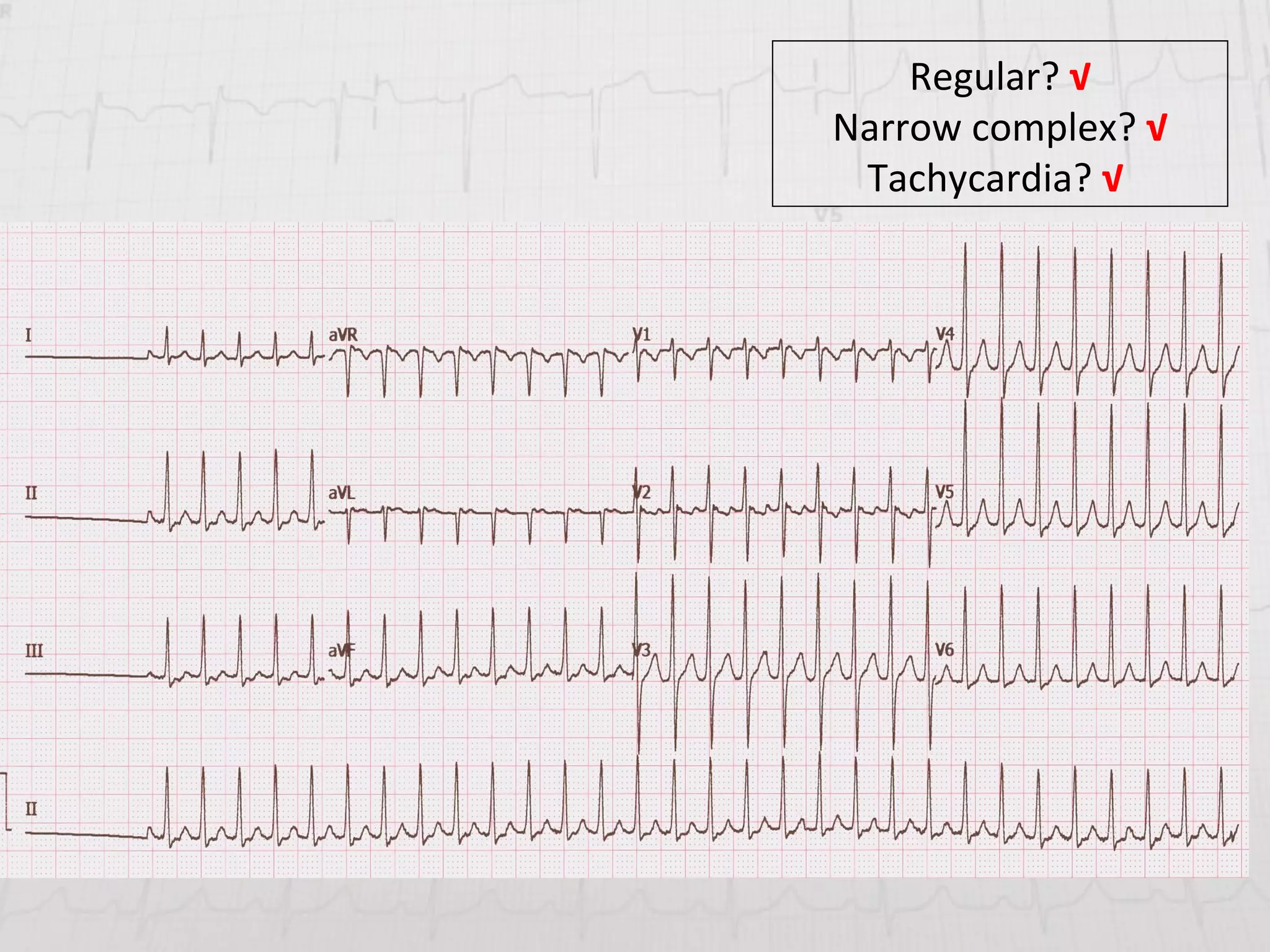 Geraldine Leong - ECG for paramedics | PPT