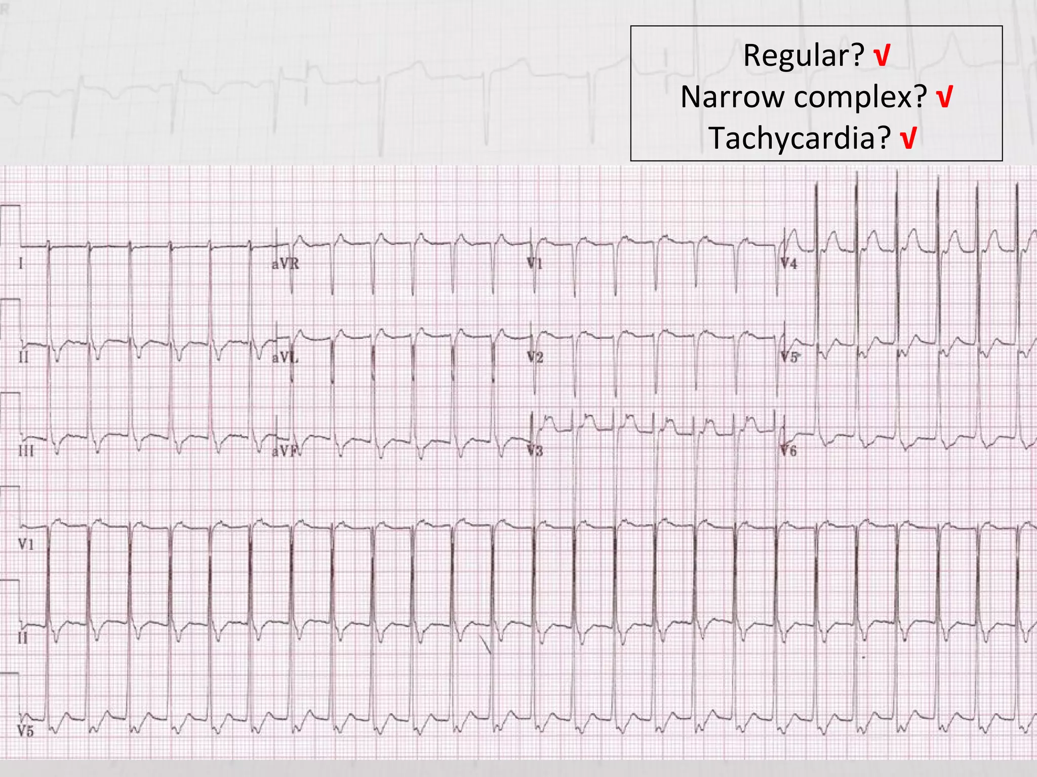 Geraldine Leong - ECG for paramedics | PPT