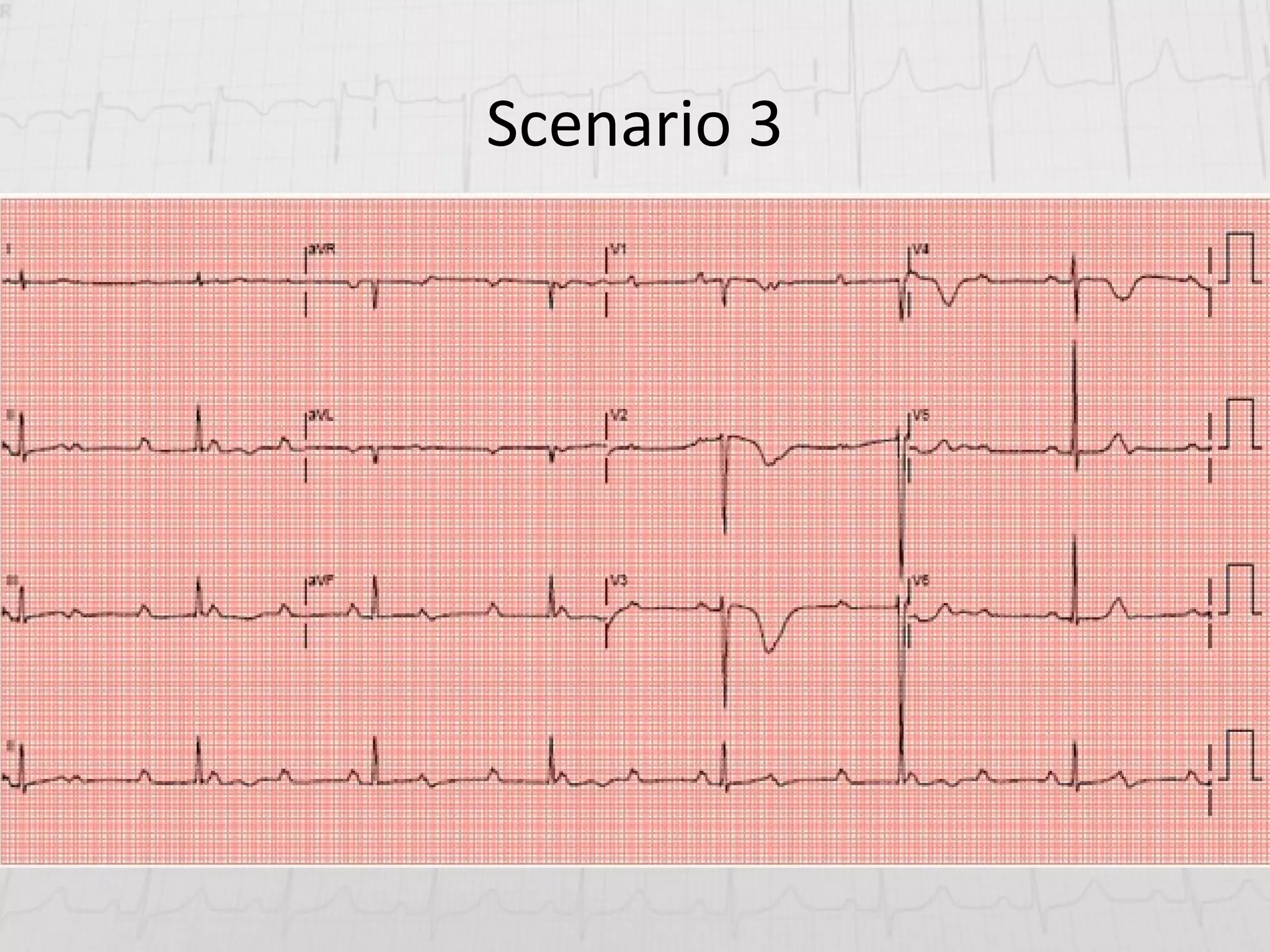 Geraldine Leong - ECG for paramedics | PPT