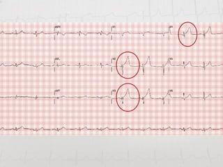 Geraldine Leong - ECG for paramedics | PPT