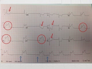 Geraldine Leong - ECG for paramedics | PPT