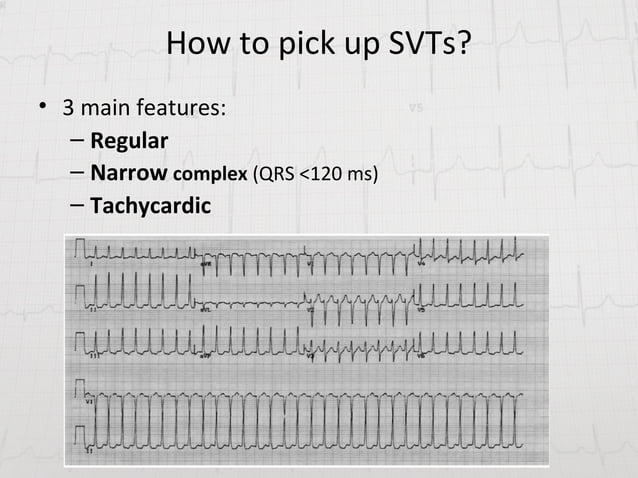 Geraldine Leong - ECG for paramedics | PPT