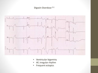 Toxicology and the ECG | PPTX