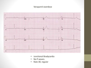 Toxicology and the ECG | PPTX
