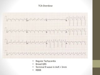 Toxicology and the ECG | PPTX