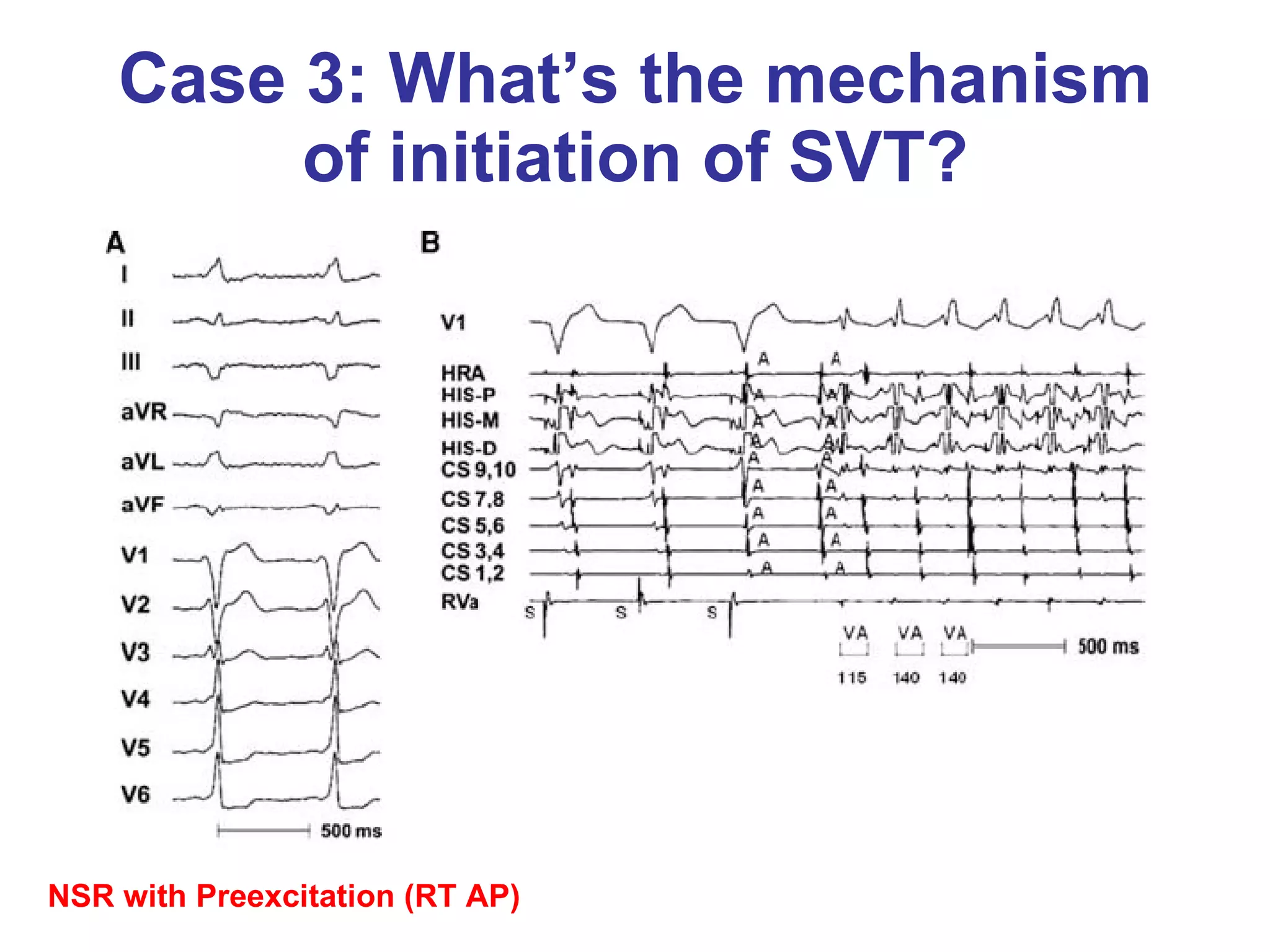 Ecg tracings teaching | PPT