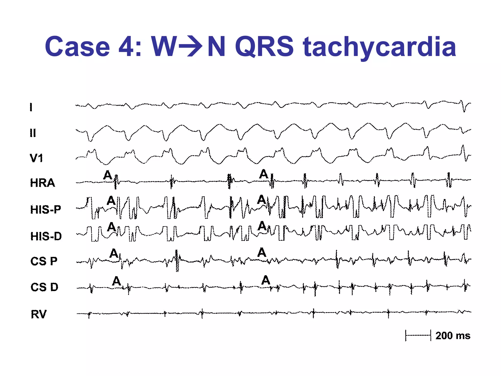 Ecg tracings teaching | PPT