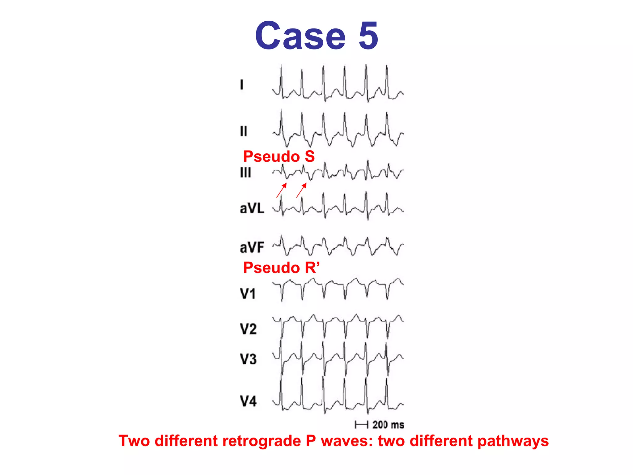 Ecg tracings teaching | PPT