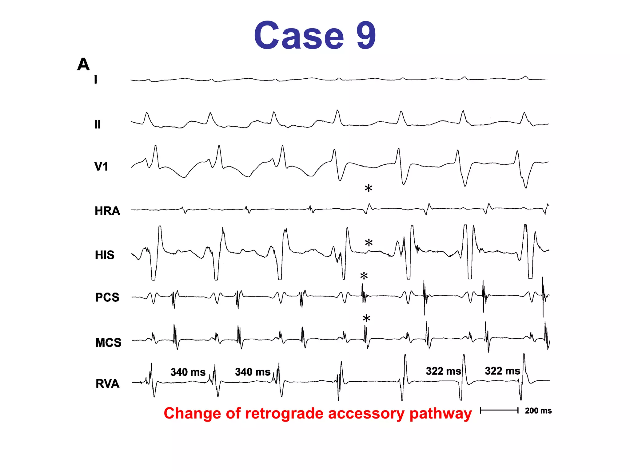 Ecg tracings teaching | PPT