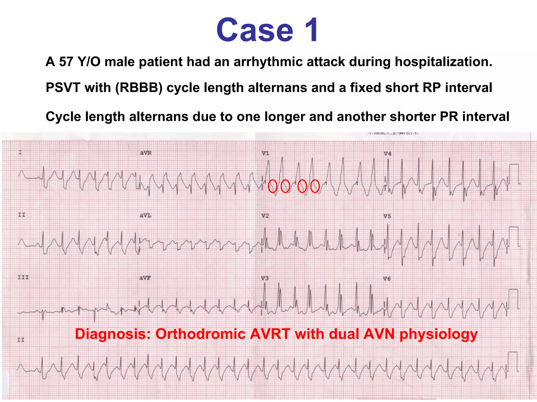Ecg tracings teaching | PPT