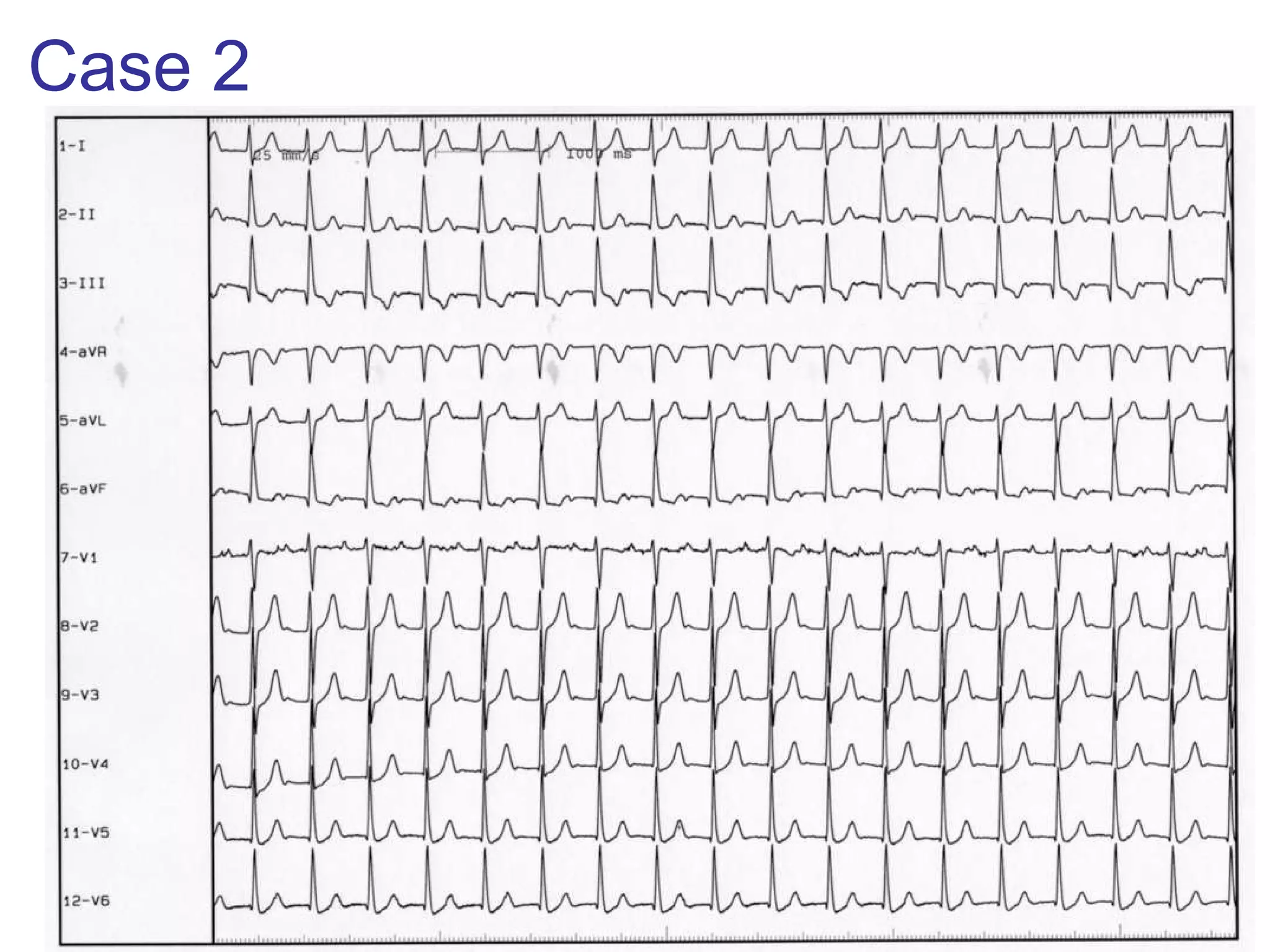 Ecg tracings teaching | PPT