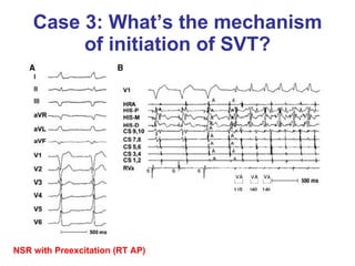 Ecg tracings teaching | PPT
