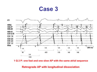 Ecg tracings teaching | PPT