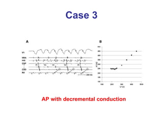 Ecg tracings teaching | PPT