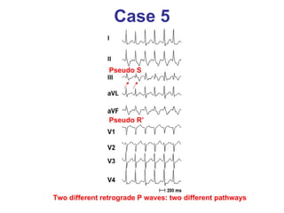 Ecg tracings teaching | PPT