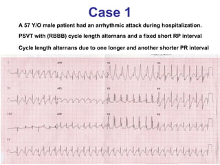 Ecg tracings teaching | PPT