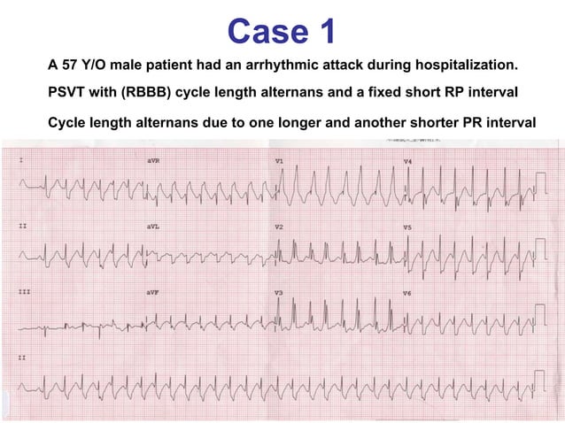Ecg tracings teaching | PPT