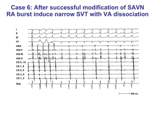 Ecg tracings teaching | PPT