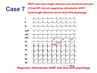 Ecg tracings teaching | PPT