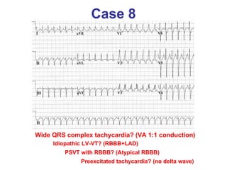 Ecg tracings teaching | PPT
