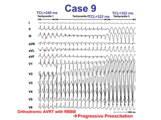 Ecg tracings teaching | PPT