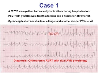 Ecg tracings teaching | PPT