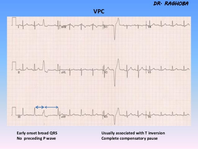 Ecg tutorial (2)