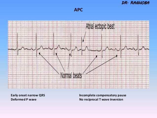 Ecg tutorial (2)