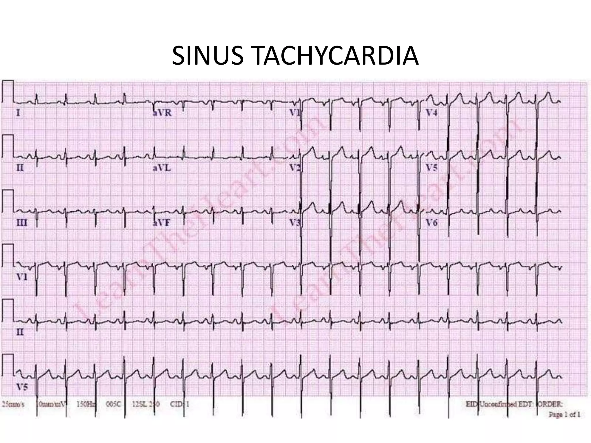 ECG TUTORIAL(Dr Israel).pptx