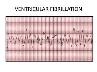 ECG TUTORIAL(Dr Israel).pptx