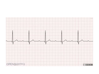 ECG TUTORIAL(Dr Israel).pptx