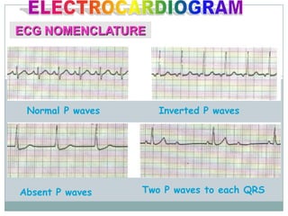 Ecg update(basic cardiology) | PPTX