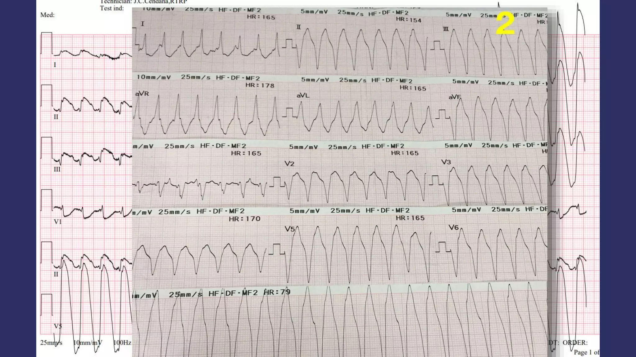 Ecg vtach brugada & vereckei algorithm mec elino | PPTX