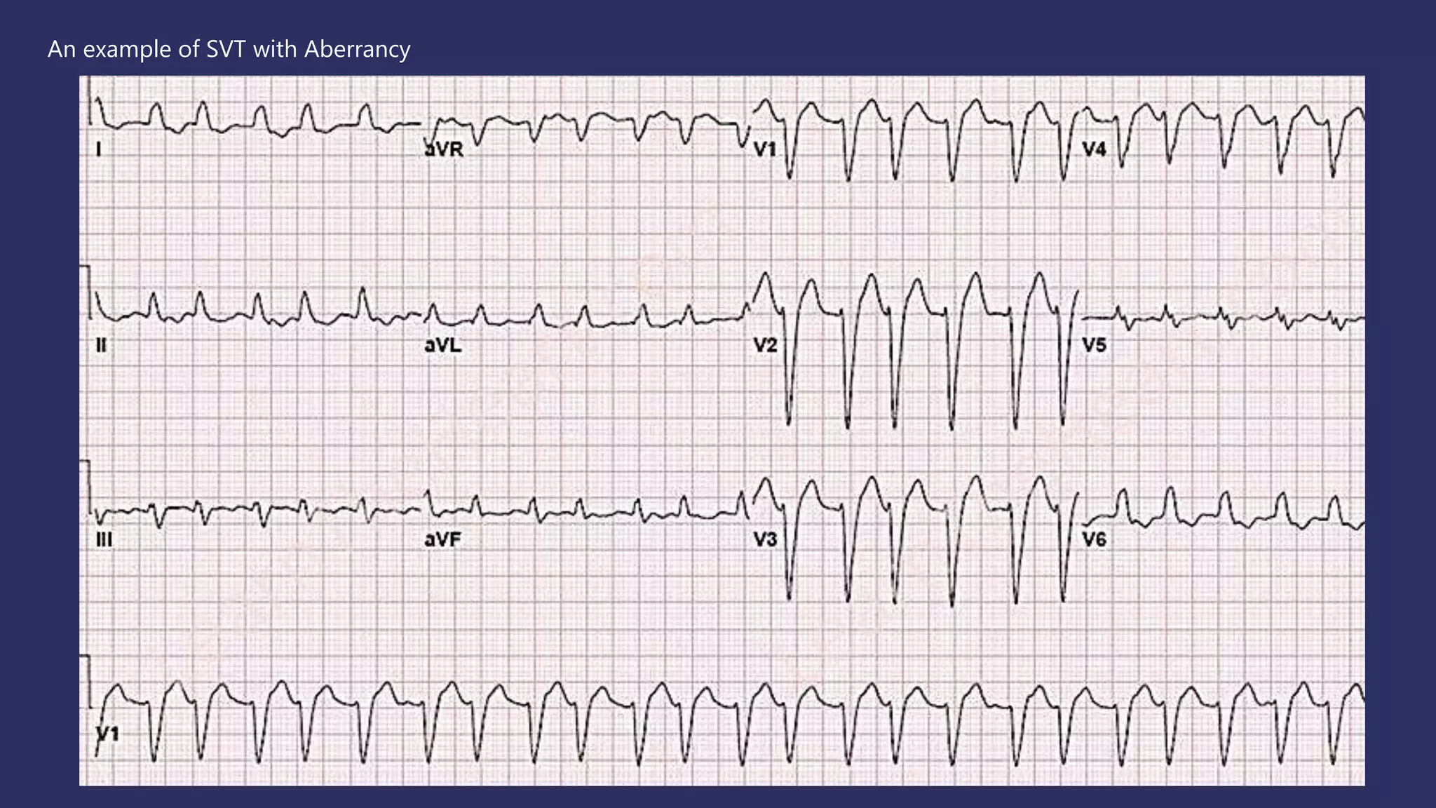 Ecg vtach brugada & vereckei algorithm mec elino | PPTX