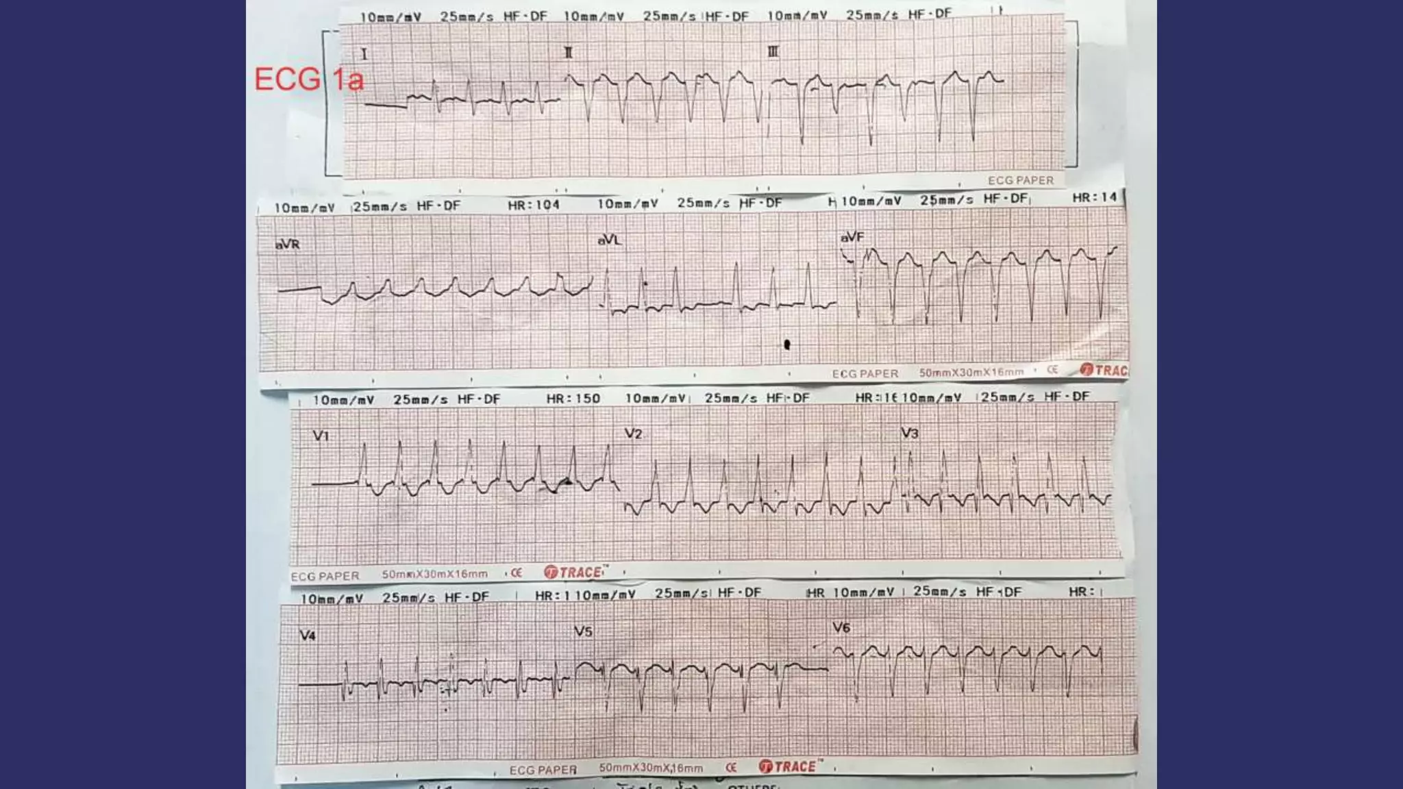 Ecg vtach brugada & vereckei algorithm mec elino | PPTX