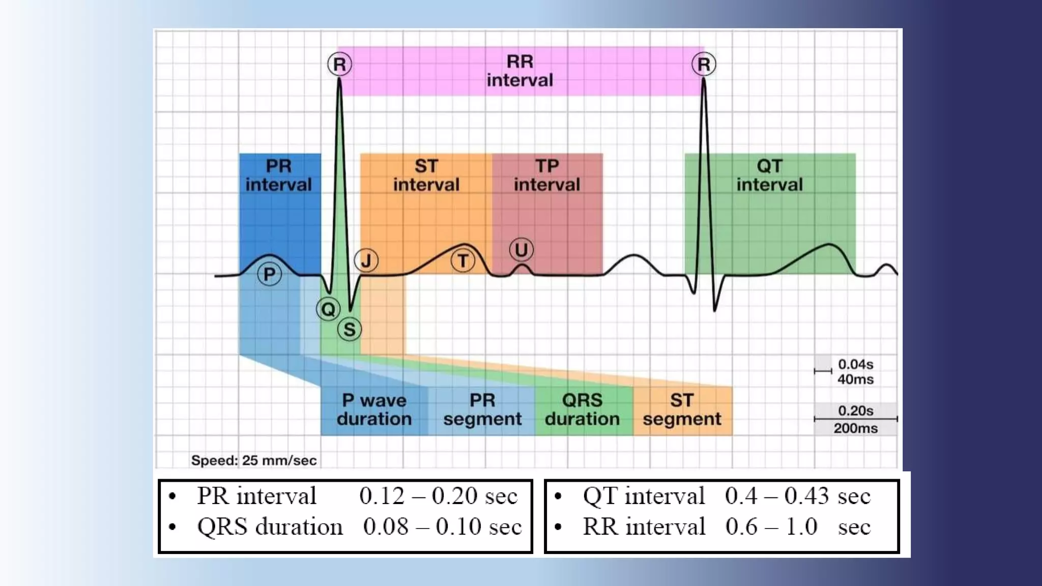 Ecg vtach brugada & vereckei algorithm mec elino | PPTX