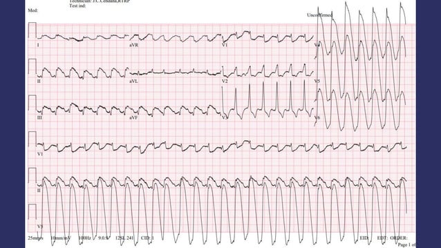 Ecg vtach brugada & vereckei algorithm mec elino | PPTX | Heart and ...