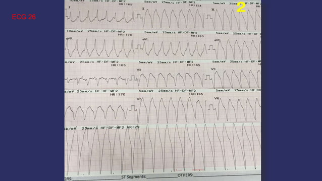 Ecg vtach brugada & vereckei algorithm mec elino | PPTX | Heart and ...