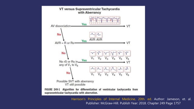 Ecg vtach brugada & vereckei algorithm mec elino | PPTX | Heart and ...