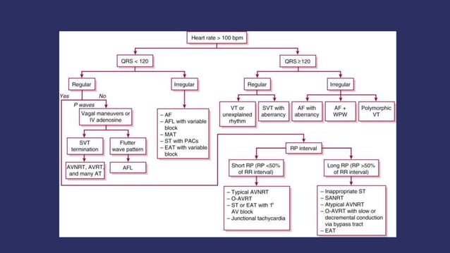 Ecg vtach brugada & vereckei algorithm mec elino | PPTX | Heart and ...