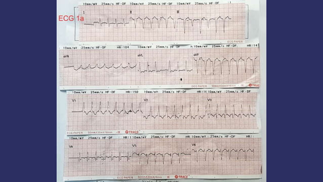 Ecg vtach brugada & vereckei algorithm mec elino | PPTX | Heart and ...