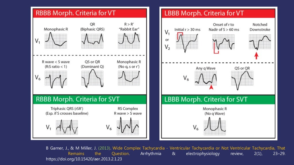 Ecg vtach brugada & vereckei algorithm mec elino