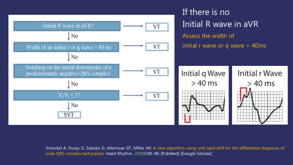 Ecg vtach brugada & vereckei algorithm mec elino