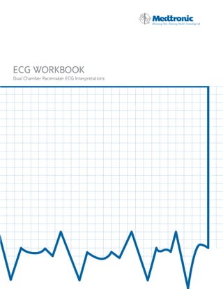 ECG tracing in pacemaker patients | PDF