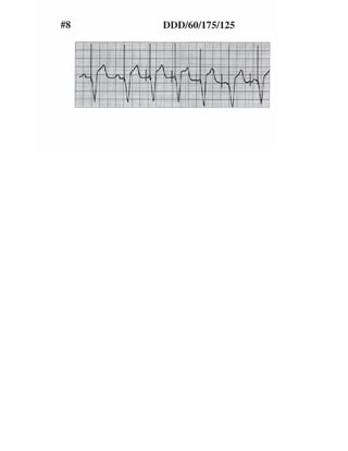 ECG tracing in pacemaker patients | PDF