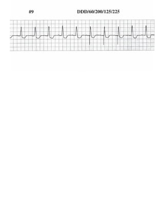 ECG tracing in pacemaker patients | PDF