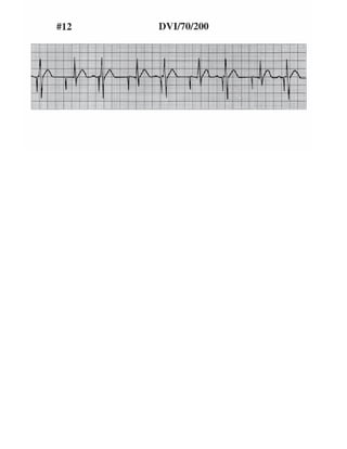ECG tracing in pacemaker patients | PDF