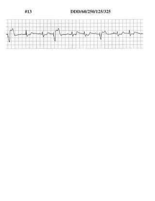 ECG tracing in pacemaker patients | PDF