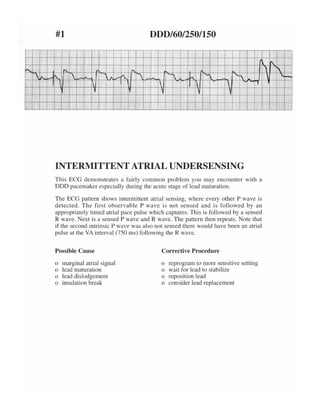 ECG tracing in pacemaker patients | PDF