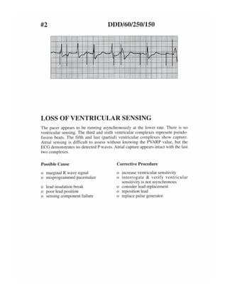 ECG tracing in pacemaker patients | PDF